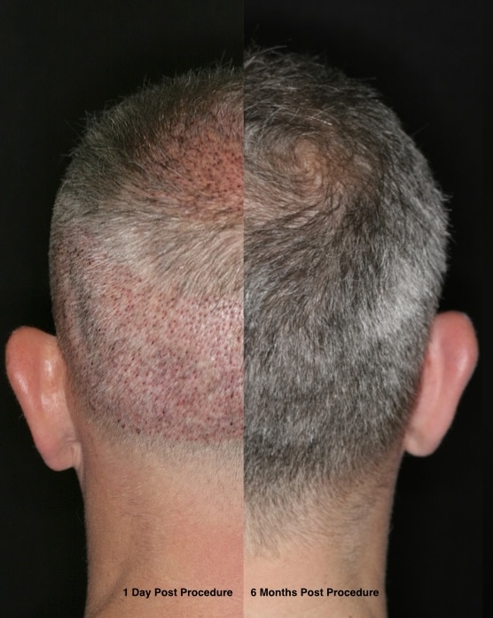 Hair Transplant Fort Lauderdale